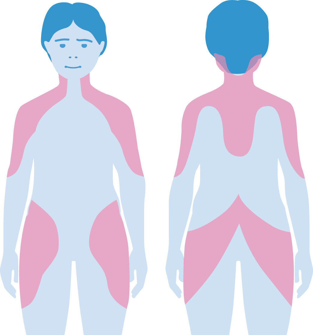Polymyalgia rheumatica